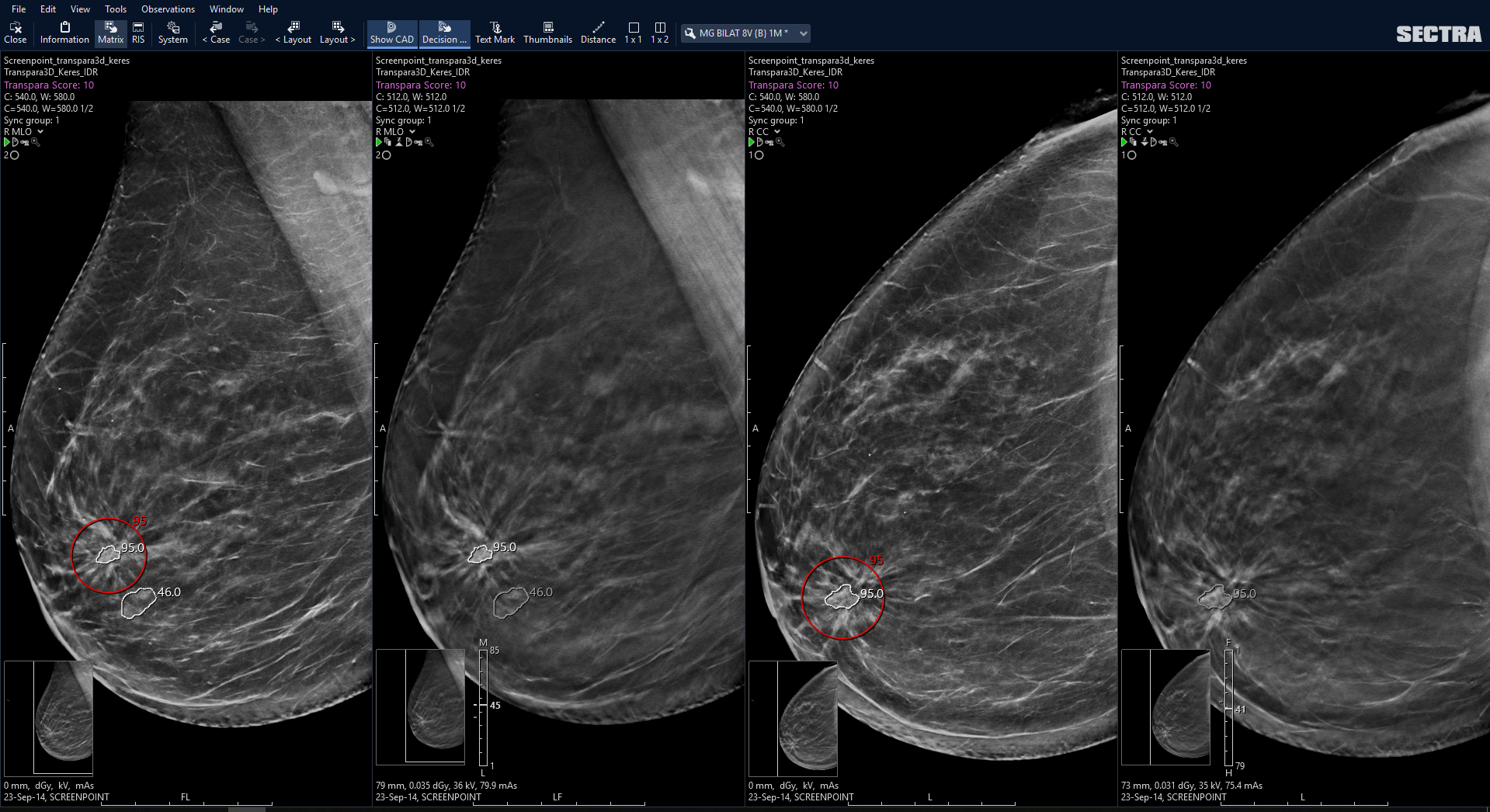 Transpara® - Sectra Amplifier Marketplace