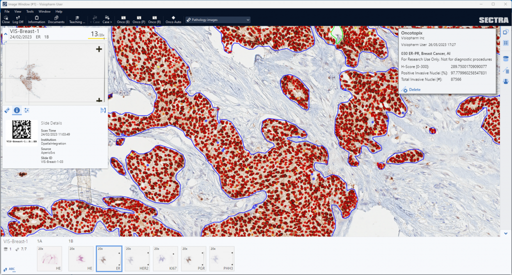 ER APP, Breast Cancer - Sectra Amplifier Marketplace