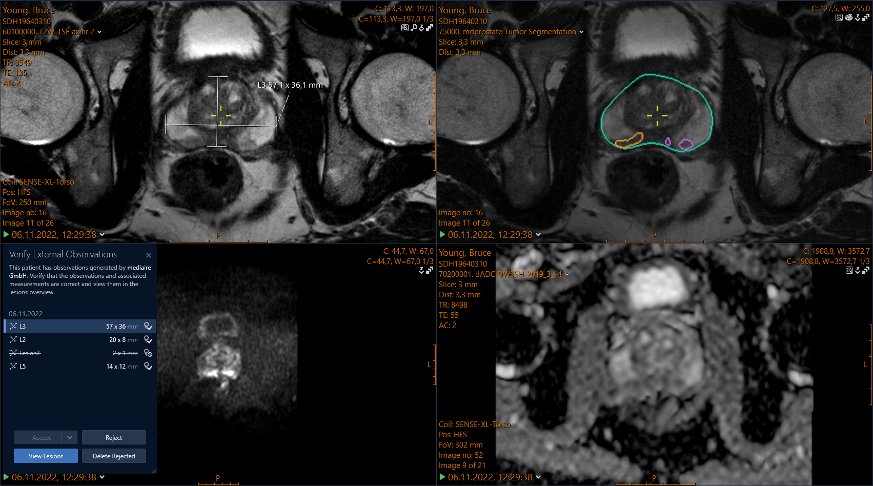 mdprostate - Sectra Amplifier Marketplace