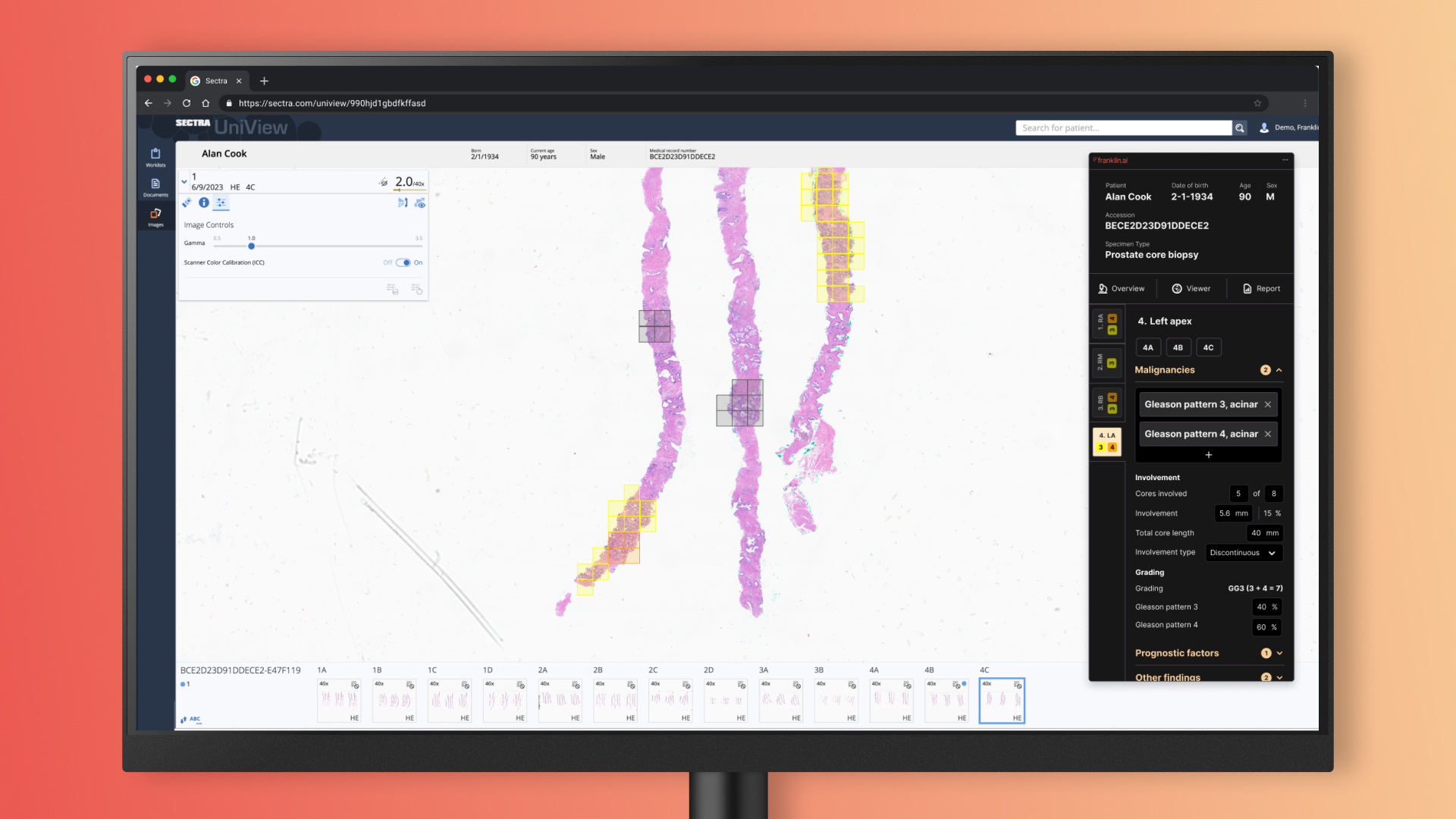 Franklin Digital Prostate - Sectra Amplifier Marketplace