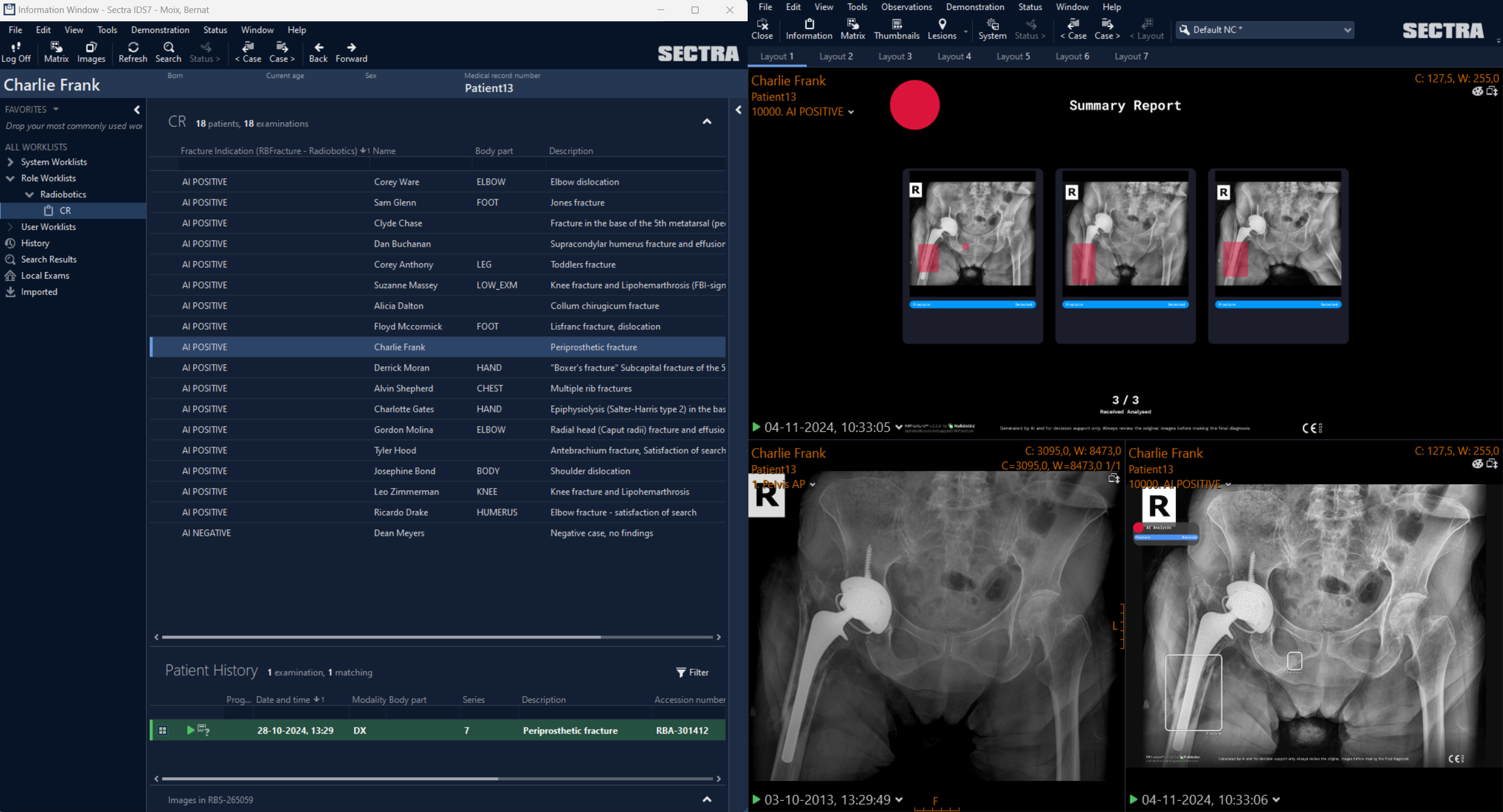 RBfracture™ - Sectra Amplifier Marketplace