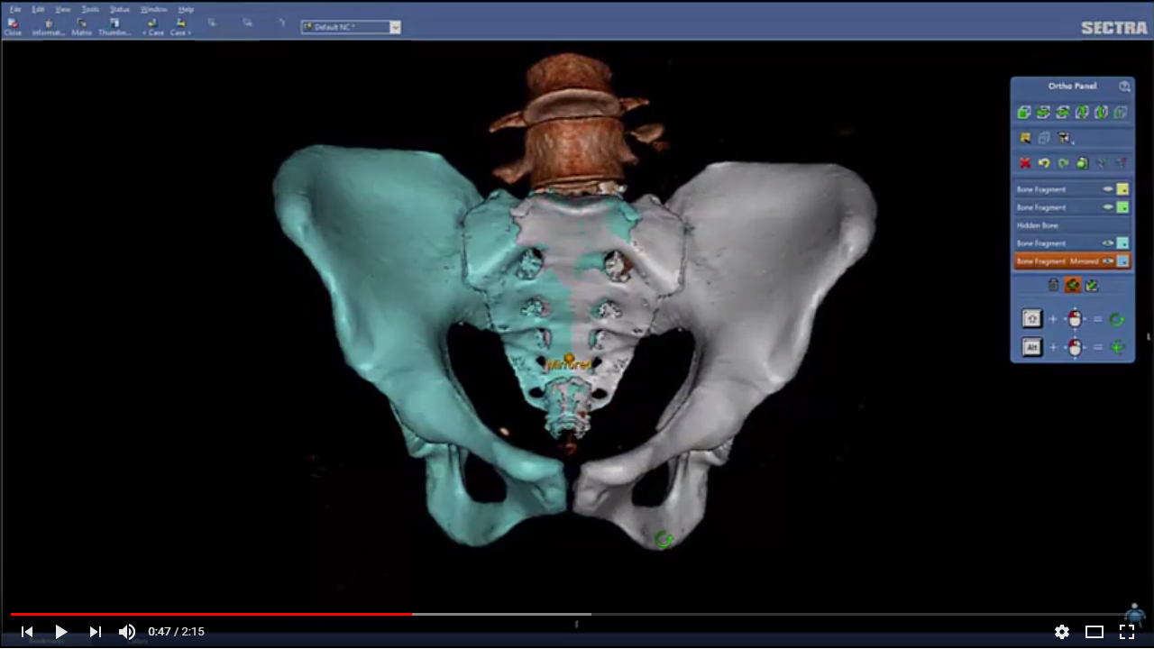 Sectra 3D Trauma for orthopaedics | Sectra Medical