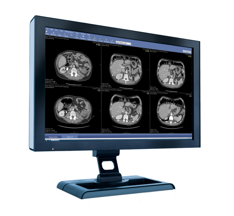 Sectra Lesion Tracking integrated in Sectra PACS | Sectra Medical
