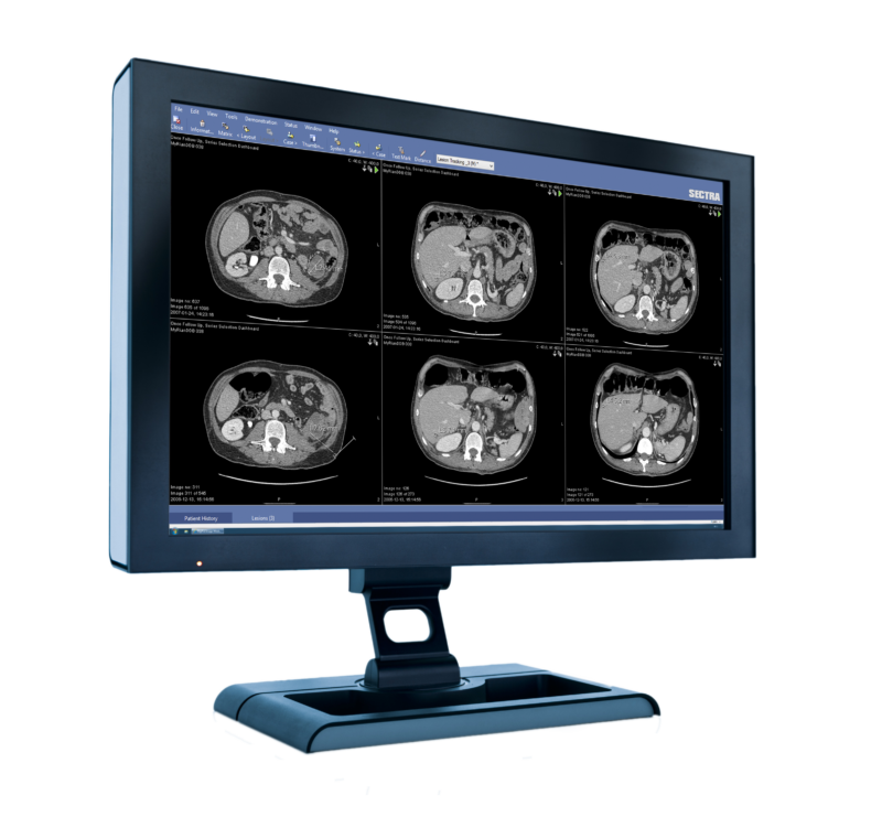 Sectra Lesion Tracking integrated in Sectra PACS | Sectra Medical