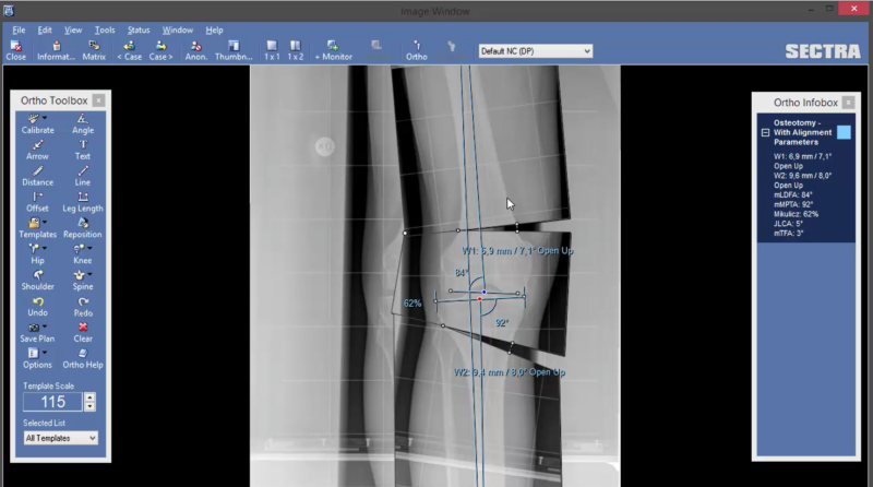Sectra 2D Planning System for orthopaedics | Sectra Medical
