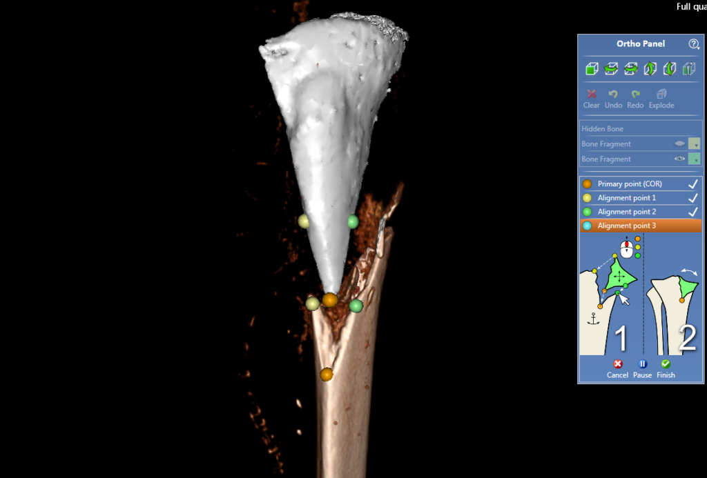 Sectra 3D Trauma for orthopaedics | Sectra Medical