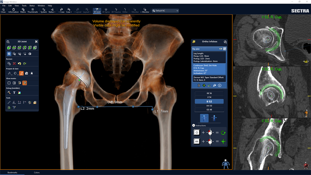 Demo video: Sectra 3D Joint Replacement | Sectra Medical