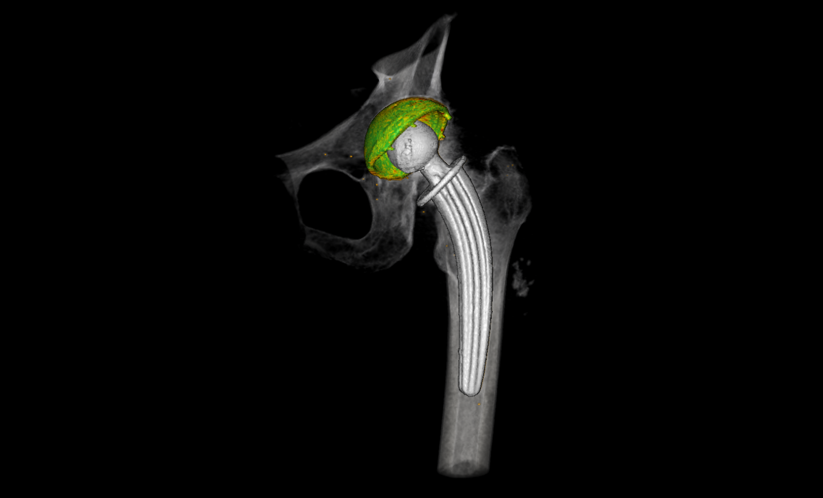 Sectra CT-based Micromotion Analysis for orthopaedics | Sectra Medical