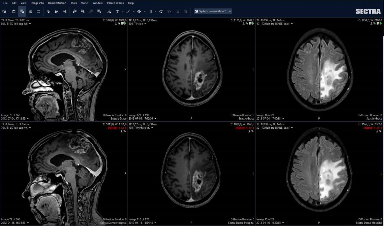 Sectra Anatomical Linking integrated in Sectra PACS | Sectra Medical