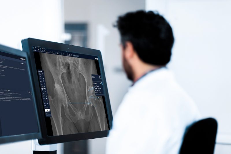 Sectra 2D Planning System for orthopaedics | Sectra Medical